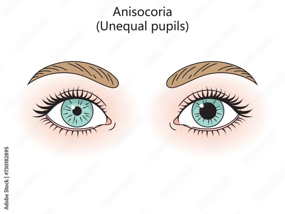 Human eyes with anisocoria diagram hand drawn schematic vector ...