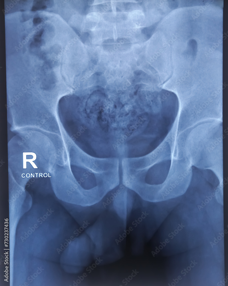 X-Ray film of RGU and MCU (Retrograde urethrogram and micturating ...