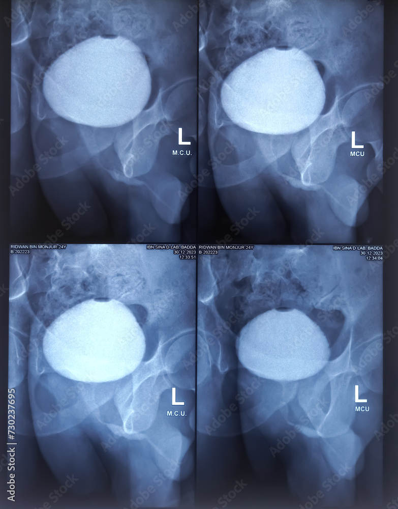 X-Ray film of RGU and MCU (Retrograde urethrogram and micturating ...