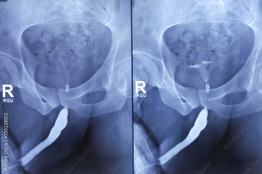 X-Ray film of RGU and MCU (Retrograde urethrogram and micturating ...