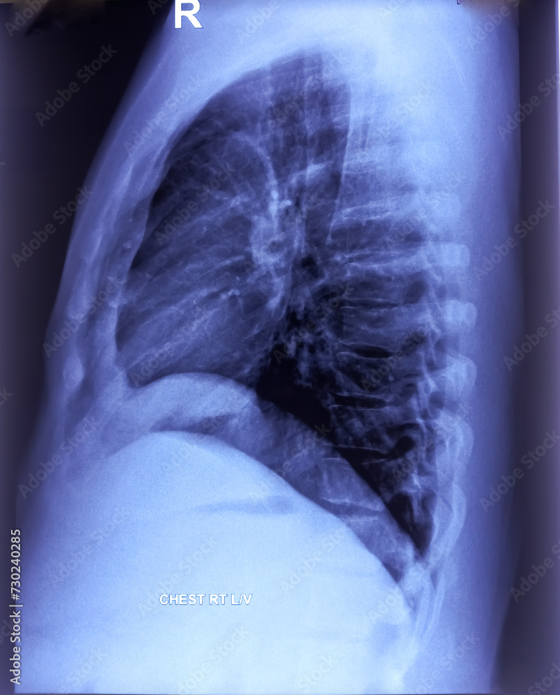 CXR PA view. Chest X-ray rediograph. Lateral view. Normal findings ...