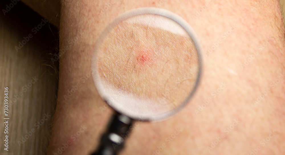 Pimple, red inflammation on the skin of the leg through a magnifying ...