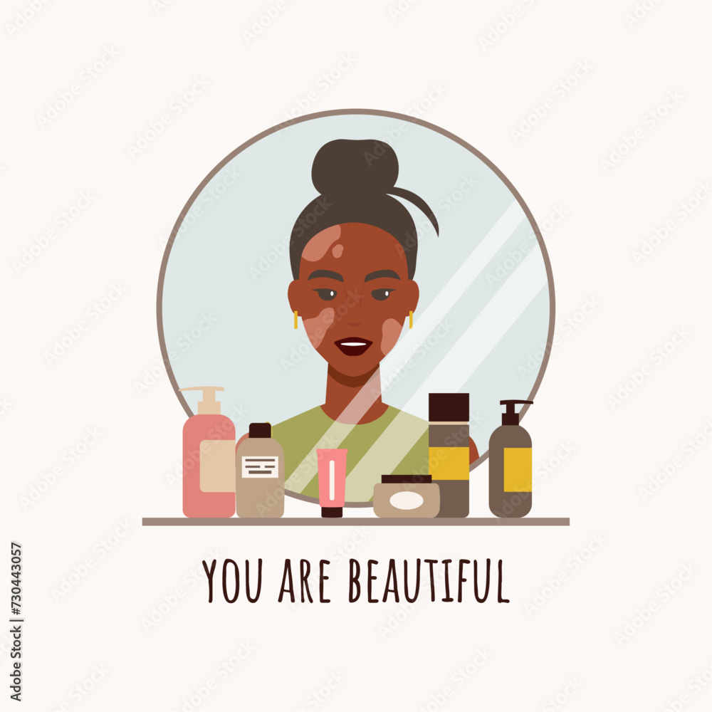 World vitiligo day concept. Young woman with vitiligo skin ...