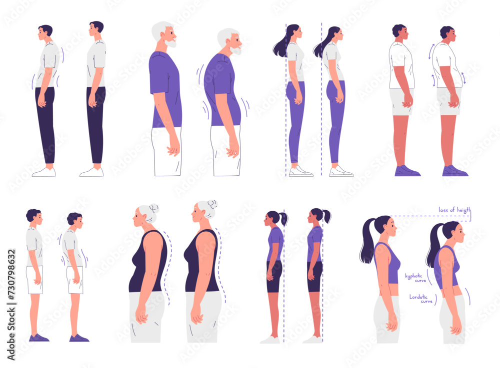 People with correct and incorrect posture. Scoliosis, curvature of the ...