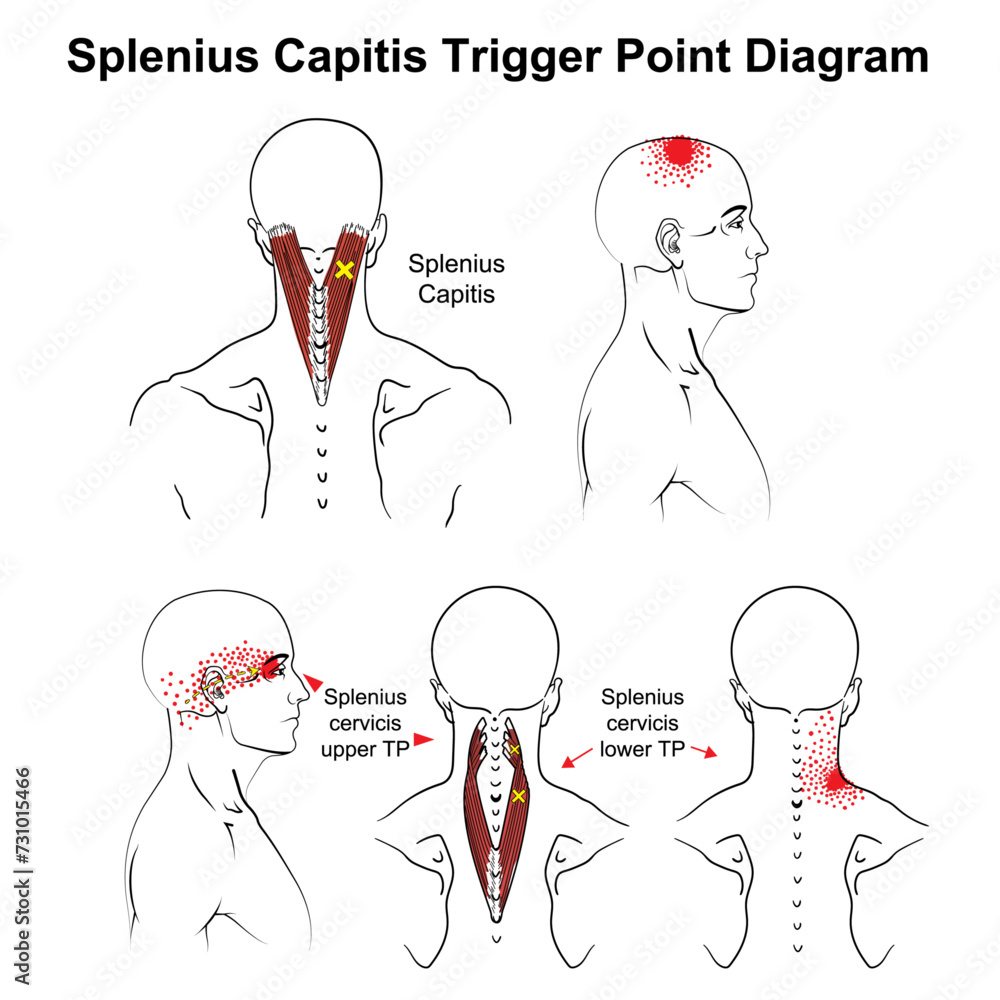 Splenius Capitis Trigger Point vector Diagram Stock Vector | Adobe Stock