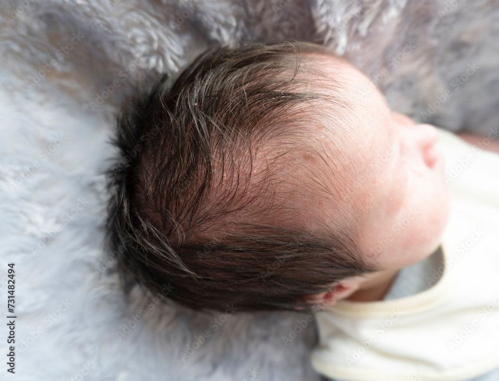 Seborrheic dermatitis crusts on the baby's head. Child with seborrhea ...