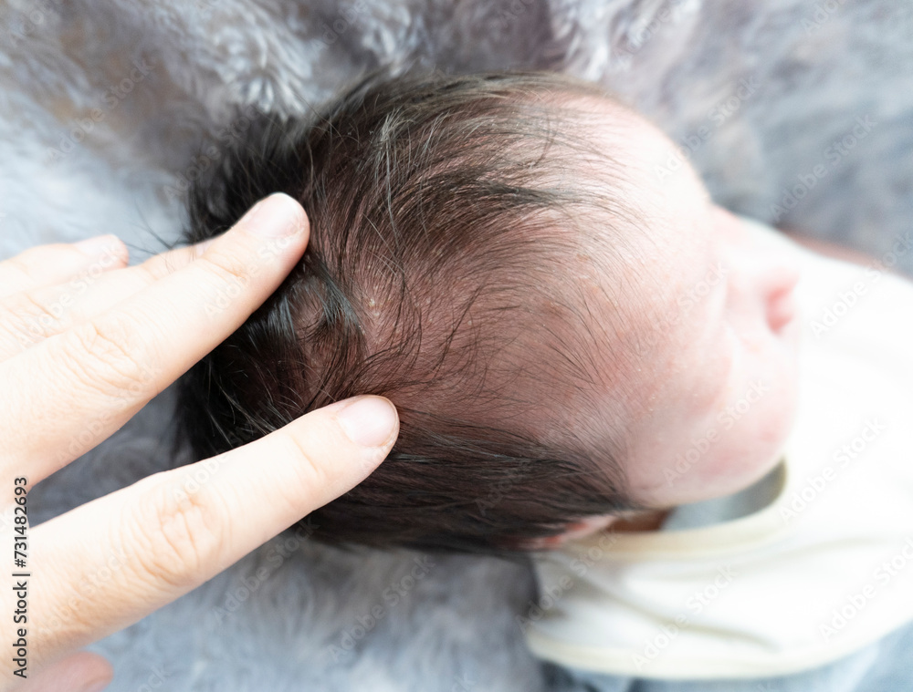 Seborrheic dermatitis crusts on the baby's head. Child with seborrhea ...