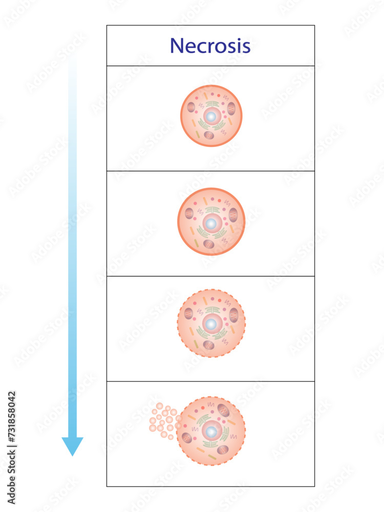 Necrosis, Pathologic Cell Death, Death of the body tissues, Cell injury ...