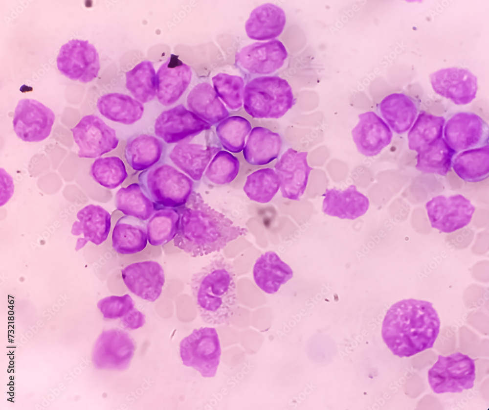 Acute myeloid leukemia (AML). Smear show shift maturation of then are ...