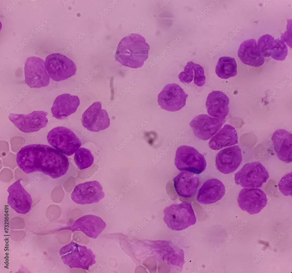 Acute myeloid leukemia (AML). Smear show shift maturation of then are ...