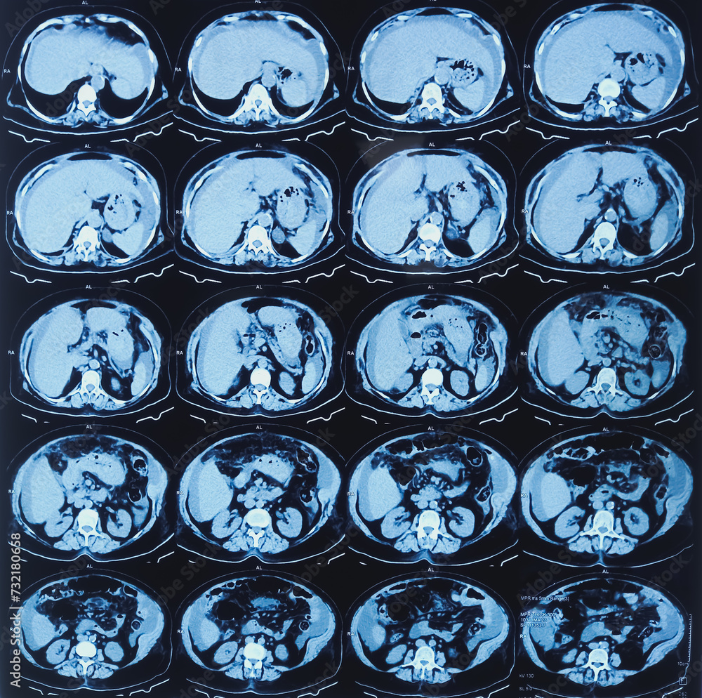 Metastatic adenocarcinoma patient. CT scan of whole abdumen. Acalculus ...