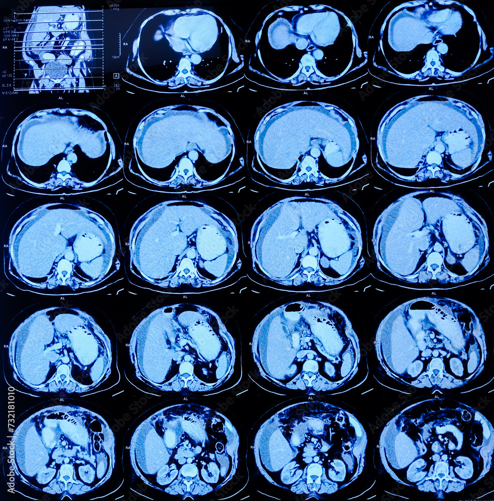 CT (computerized tomography) urogram. Spindle cell tumor of left testis ...