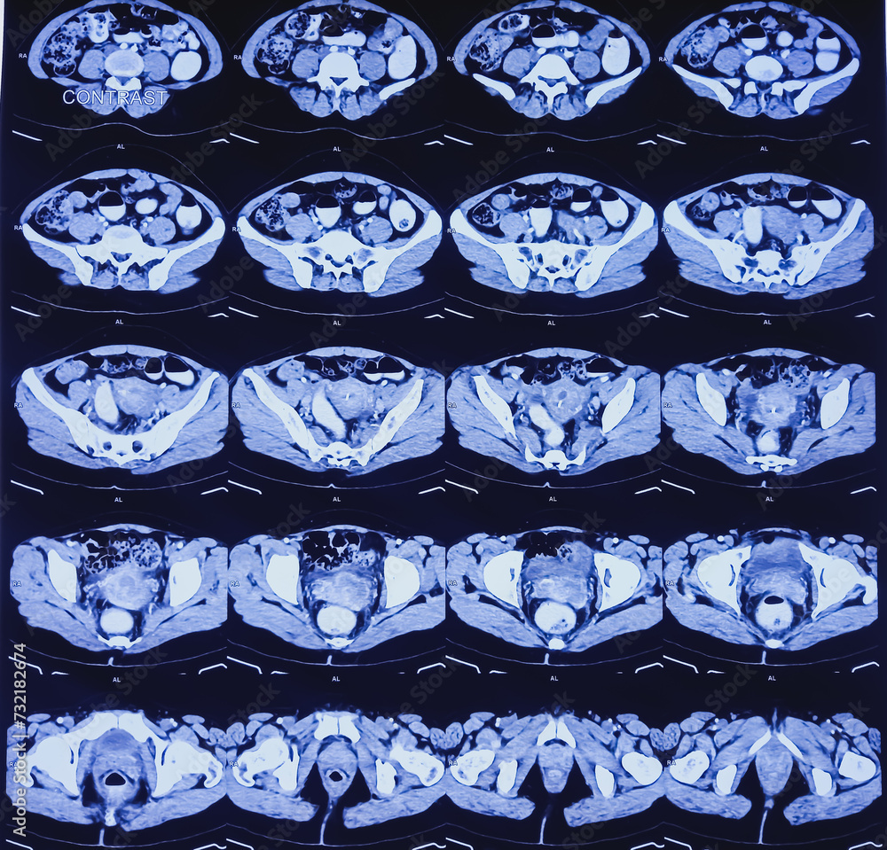 Cervix carcinoma. CT scan of cervix of uterus. Cu-T noted in situ in ...