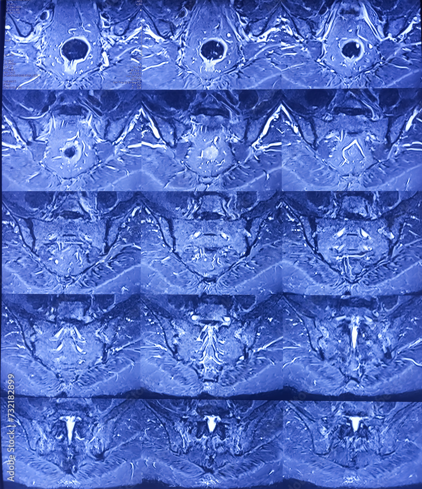 MRI of SI (Sacroiliac) joint. Screening of lumbar spine: Lumbar ...