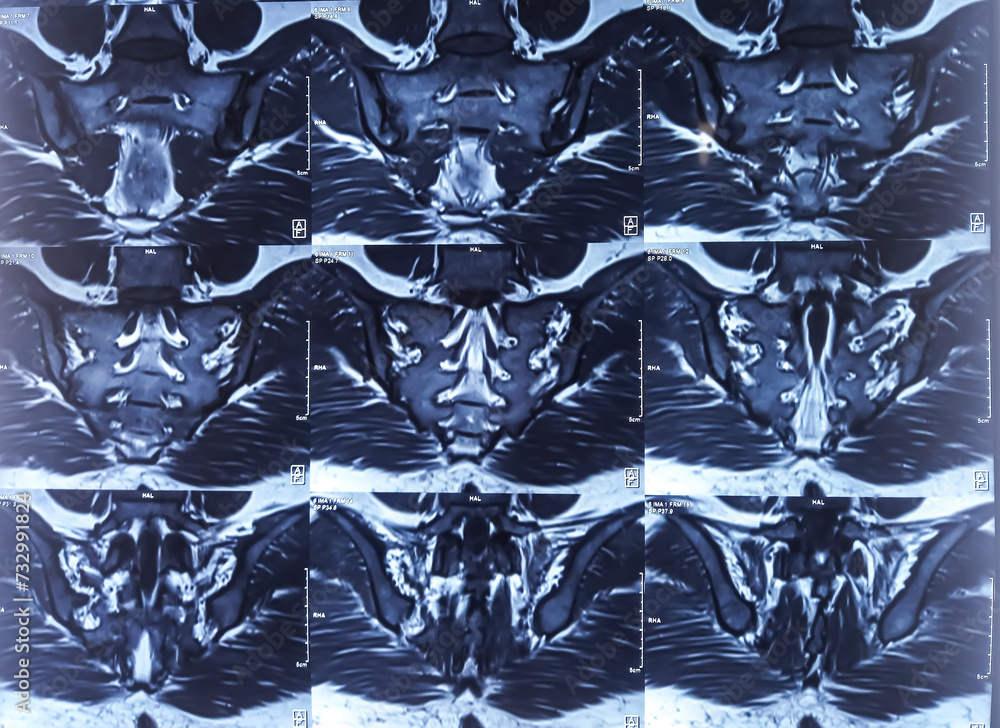 MRI (magnetic resonance imaging) of Lumbo sacral Spine. Degenerative ...