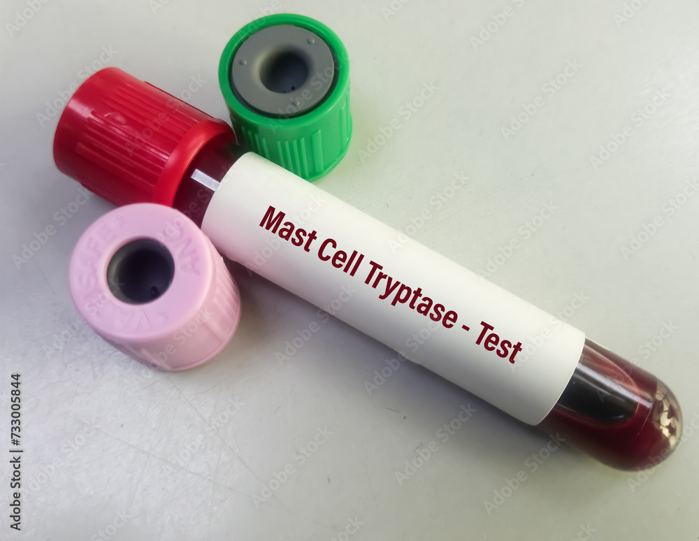 Blood sample for Mast cell Tryptase test. A tryptase test can help ...
