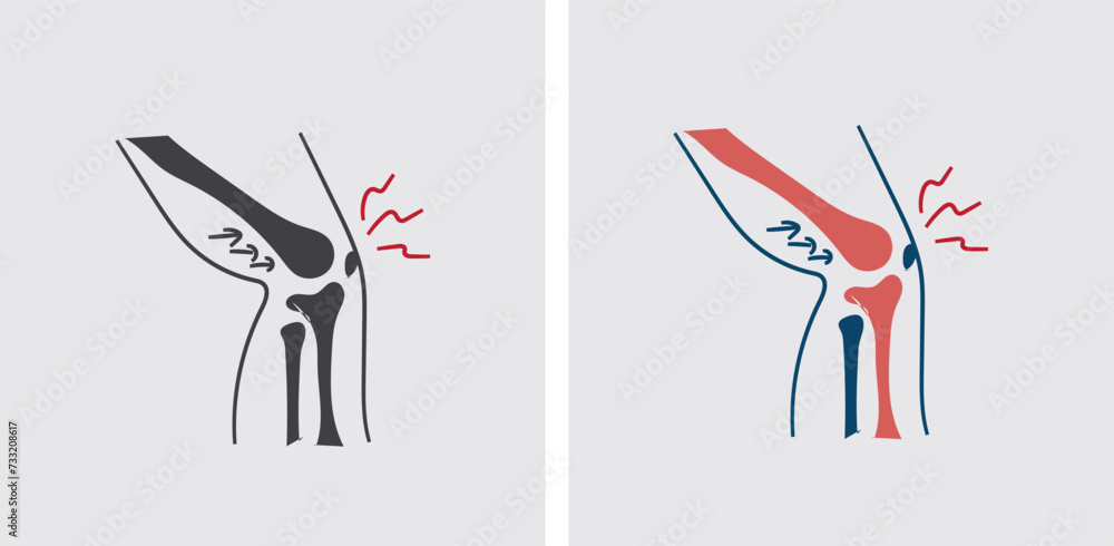 During knee replacement surgery, the orthopedic surgeon makes an ...