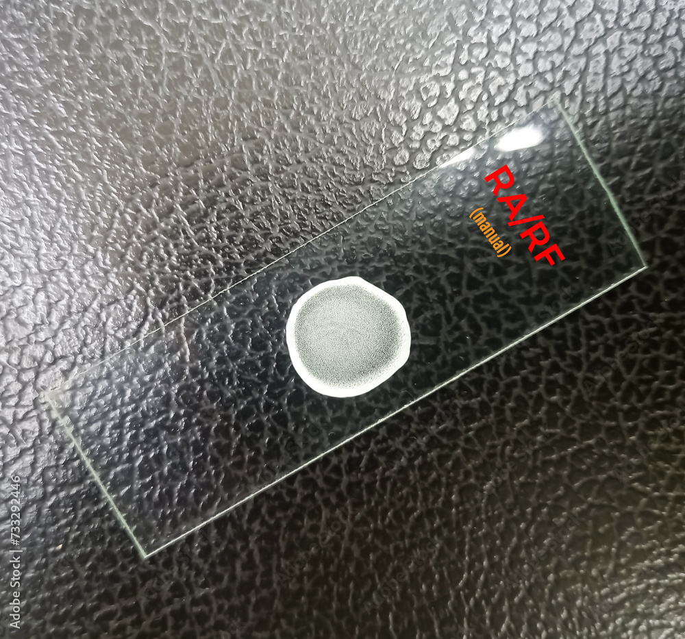 Blood agglutination test for RA or RF test, to diagnosis of Rheumatoid ...