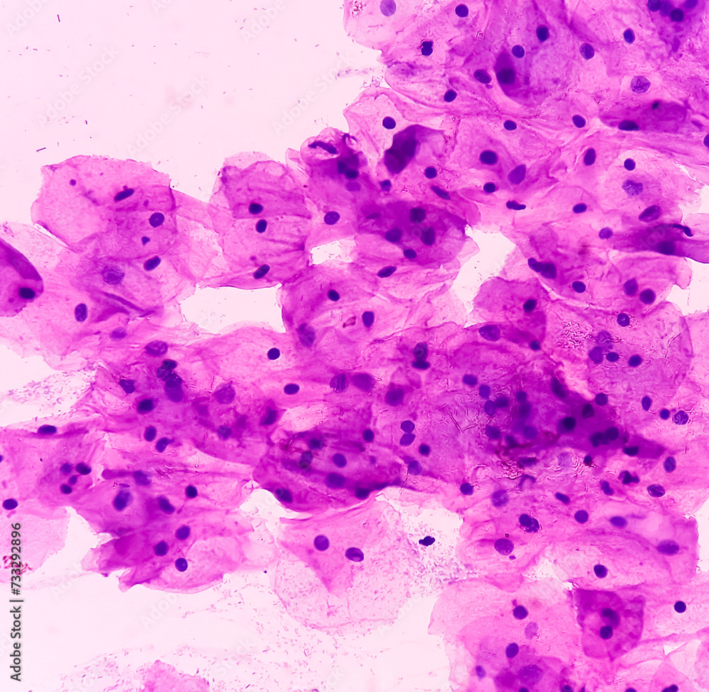 Pap's smear. Microscopic examination of pap smear showing inflammatory ...
