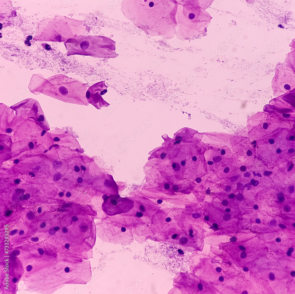 Pap's smear. Microscopic examination of pap smear showing inflammatory ...