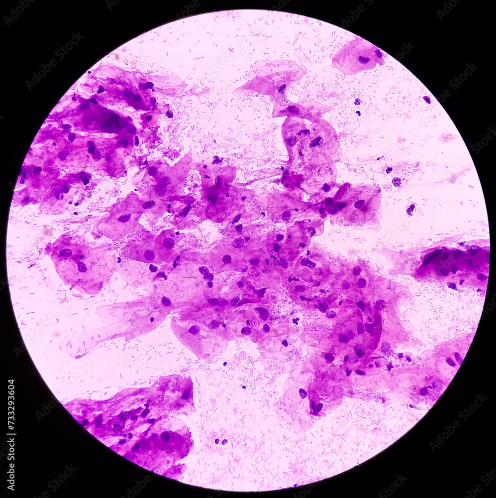 Pap's smear. Microscopic examination of pap smear showing inflammatory ...