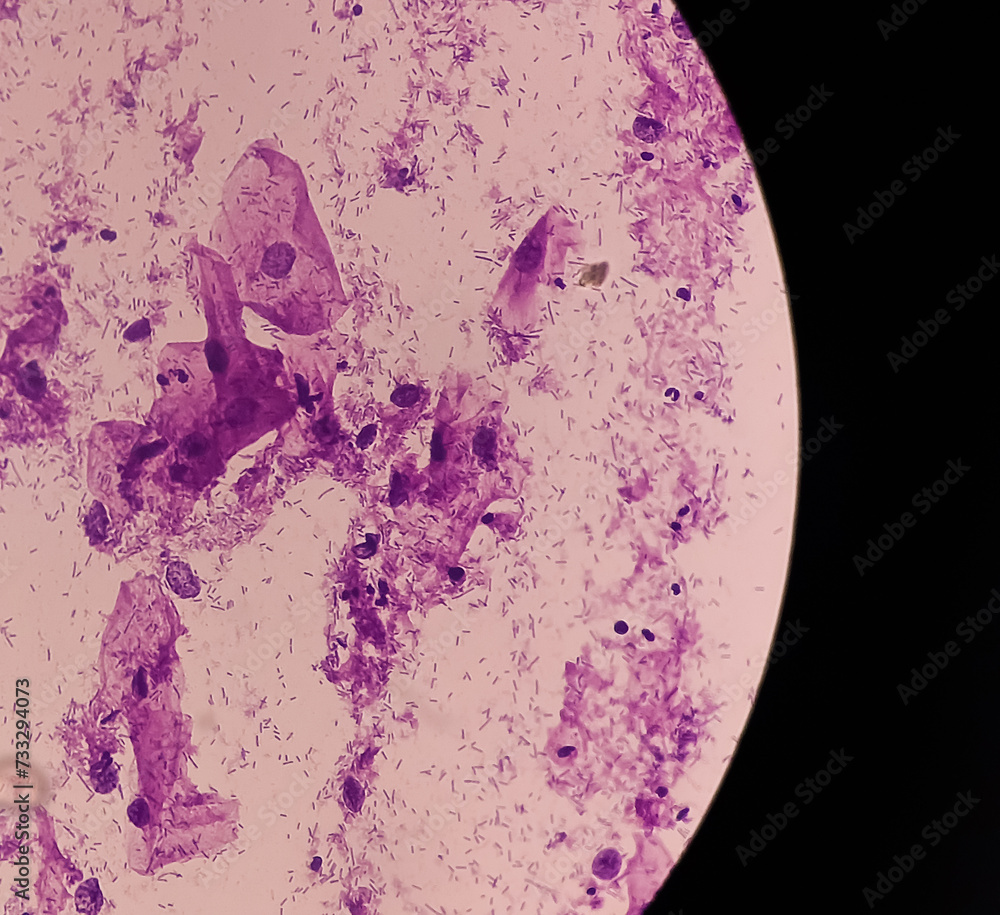 Pap's smear. Microscopic examination of pap smear showing inflammatory ...