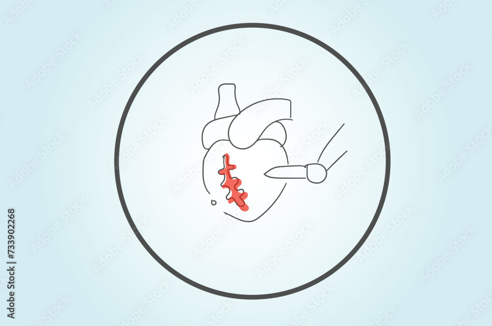 Coronary Artery Bypass Grafting (CABG) is a surgical procedure used to ...