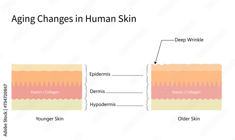 Aging Changes in Younger,older skin.anatomy, collagen,elastin. Visual ...