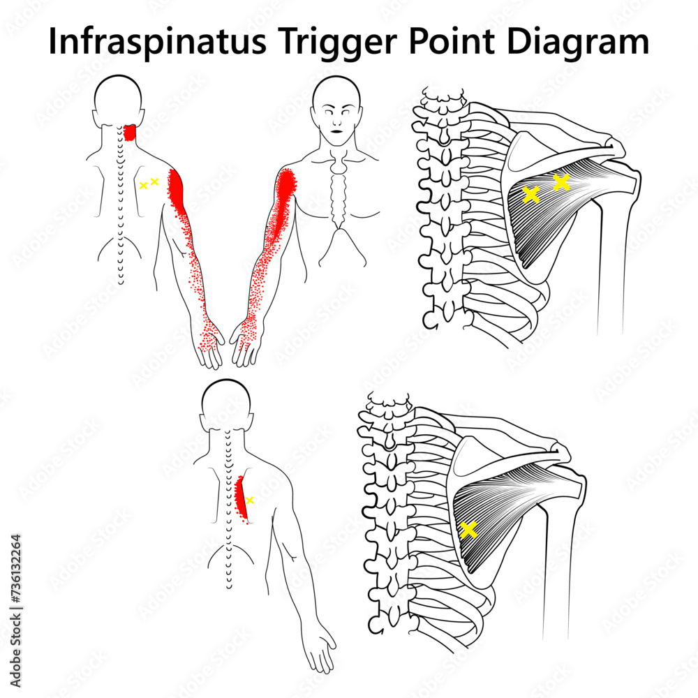 Infraspinatus Trigger Point Diagram Stock Vector | Adobe Stock