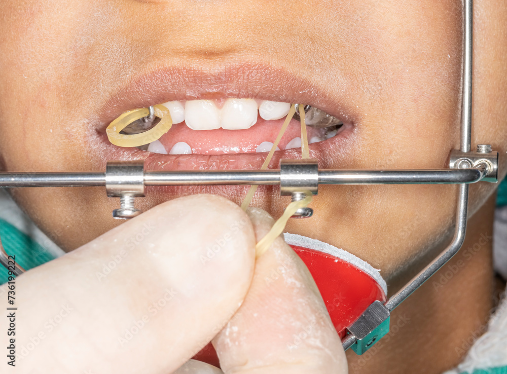 Fingers with orthodontic dentist's gloves connecting the Delaire face ...