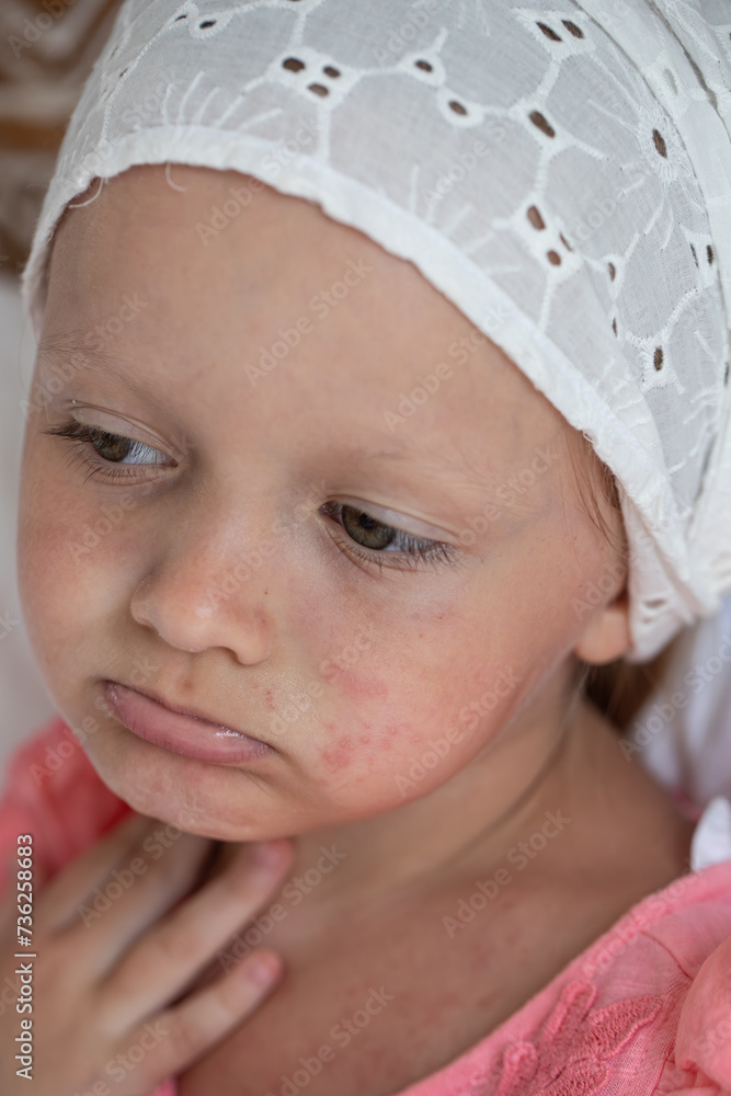 Singapore flu, skin rashes, blisters, viral infection, disease Stock ...