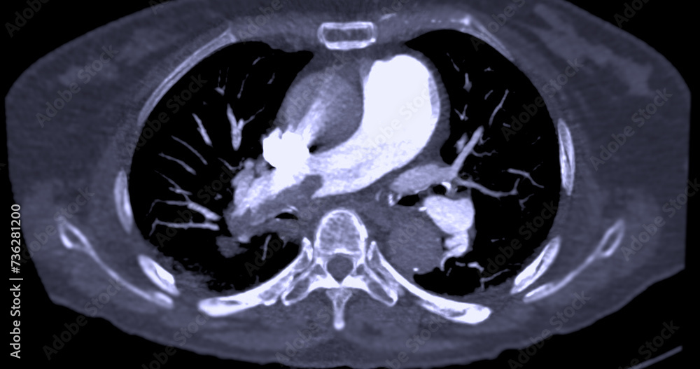 A CTA pulmonary artery reveals a detailed view of the lung blood ...