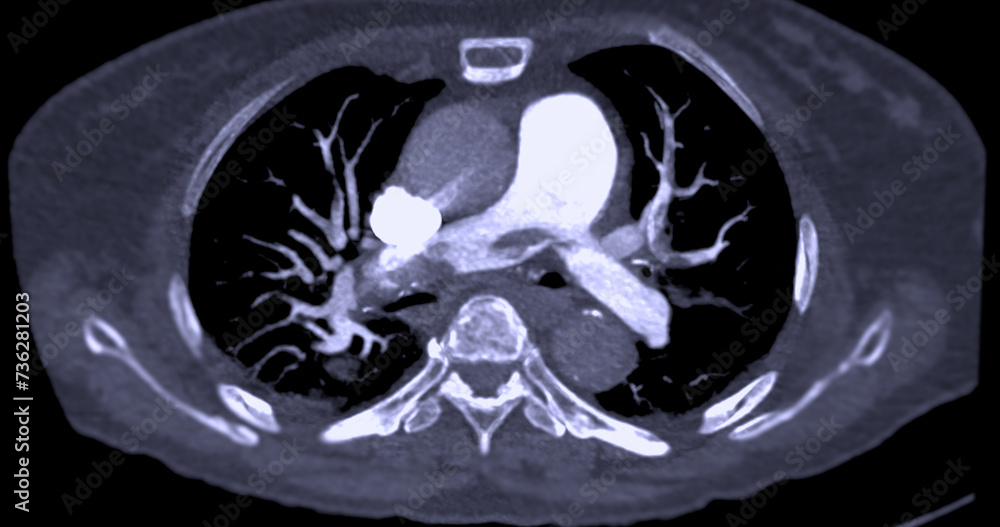 A CTA pulmonary artery reveals a detailed view of the lung blood ...