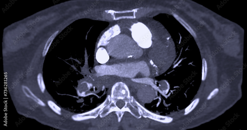 A CTA pulmonary artery reveals a detailed view of the lung blood ...