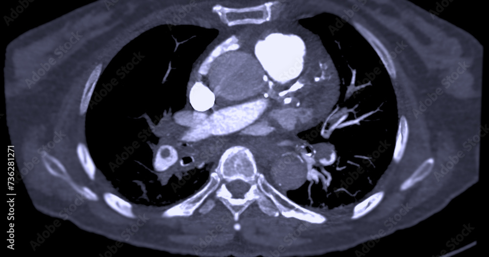 A CTA pulmonary artery reveals a detailed view of the lung blood ...