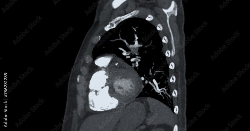 A CTA pulmonary artery reveals a detailed view of the lung blood ...