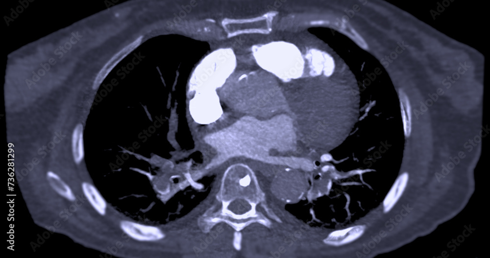A CTA pulmonary artery reveals a detailed view of the lung blood ...