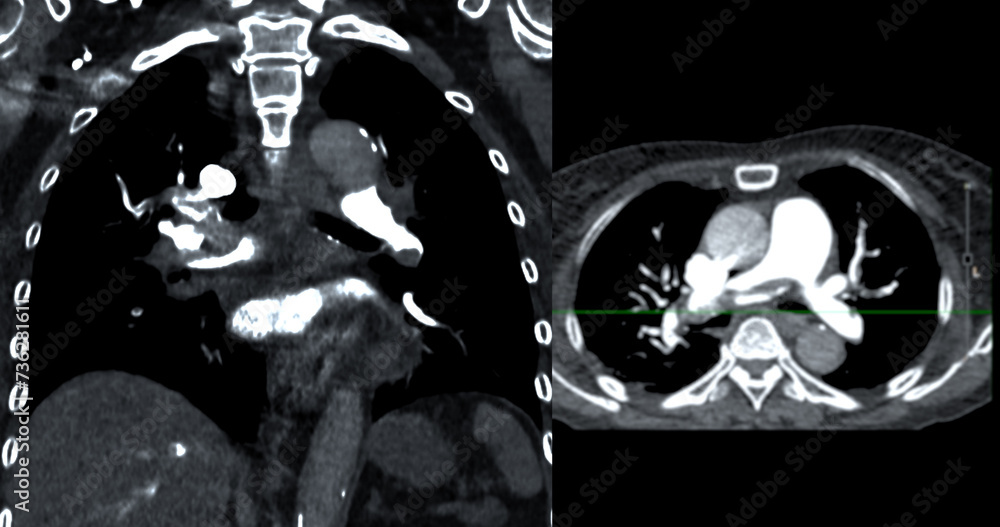 A CTA pulmonary artery reveals a detailed view of the lung blood ...