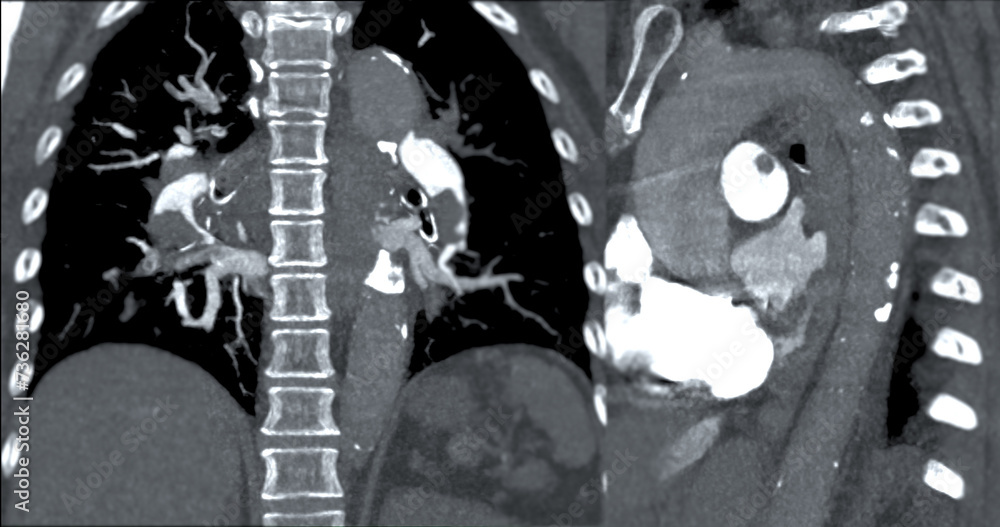 A CTA pulmonary artery reveals a detailed view of the lung blood ...