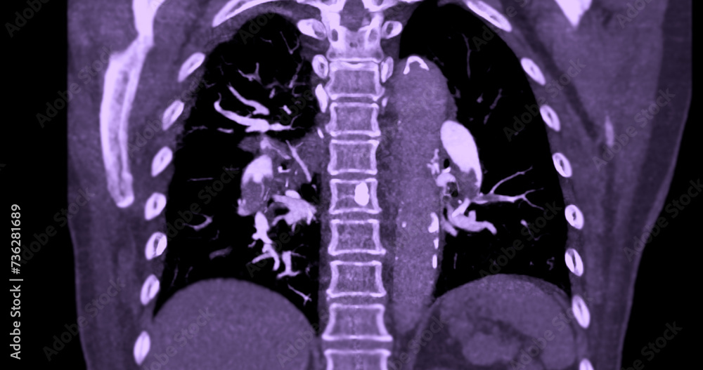 A CTA pulmonary artery reveals a detailed view of the lung blood ...