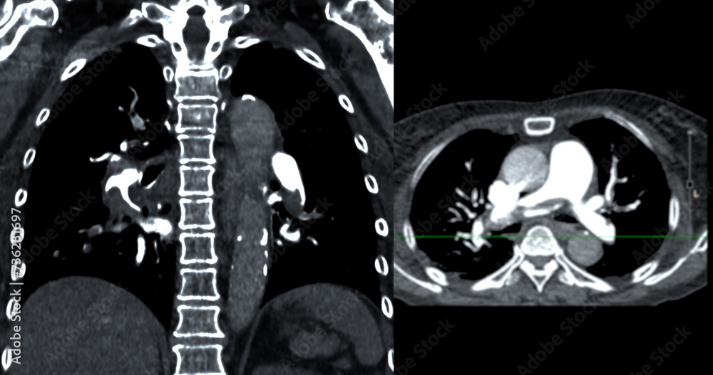 A CTA pulmonary artery reveals a detailed view of the lung blood ...