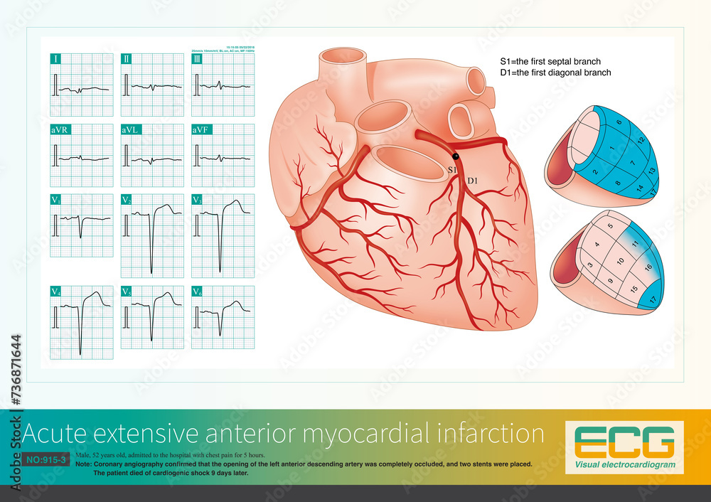 When the opening of left anterior descending artery is occluded, it can ...