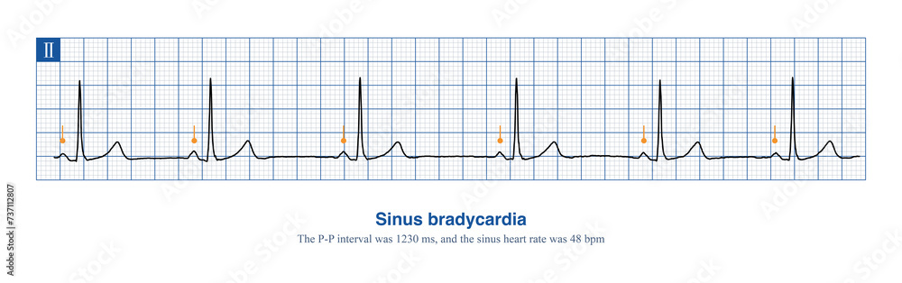 When the frequency of sinus rhythm is less than 60 beats per minute, it ...
