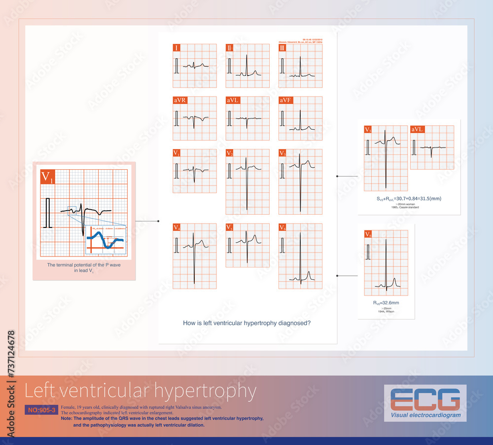When the left ventricle dilates, the amplitude of the QRS wave ...
