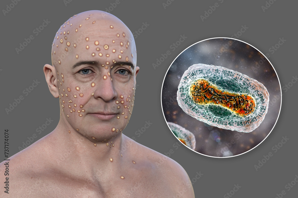 3D illustration depicts man with rash from pox viruses (smallpox ...