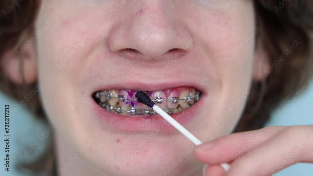 Plaque indicator on human teeth with braces. Plaque is colored pink ...