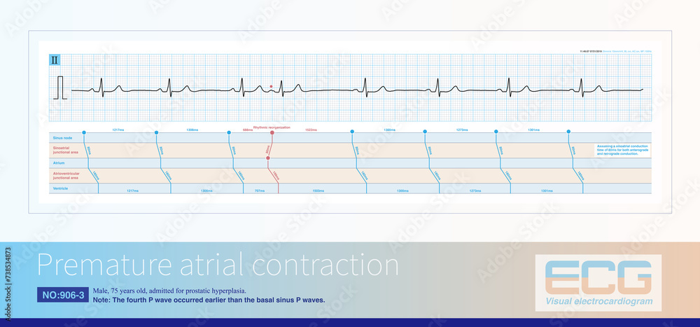 The ECG diagnosis of atrial premature contraction is an early P wave ...