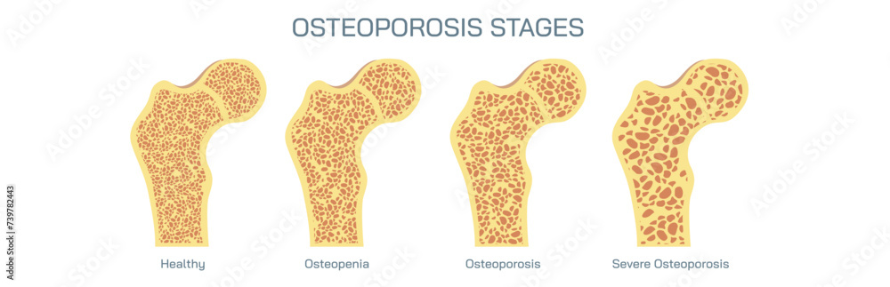 Bone density measurements and stages of osteoporosis. A bone disease ...
