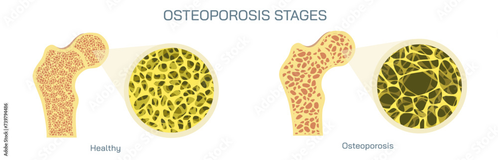 Bone density measurements and stages of osteoporosis. A bone disease ...