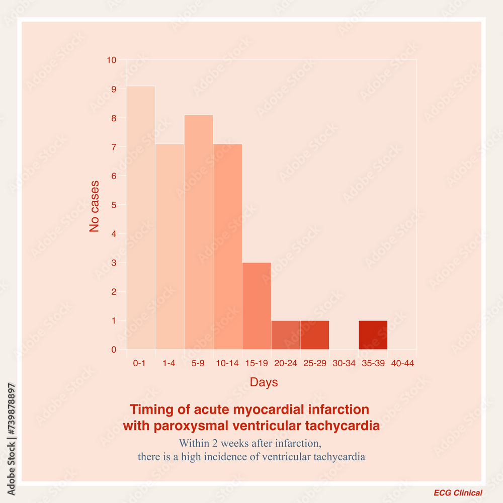 After acute myocardial infarction, there is a high incidence of ...
